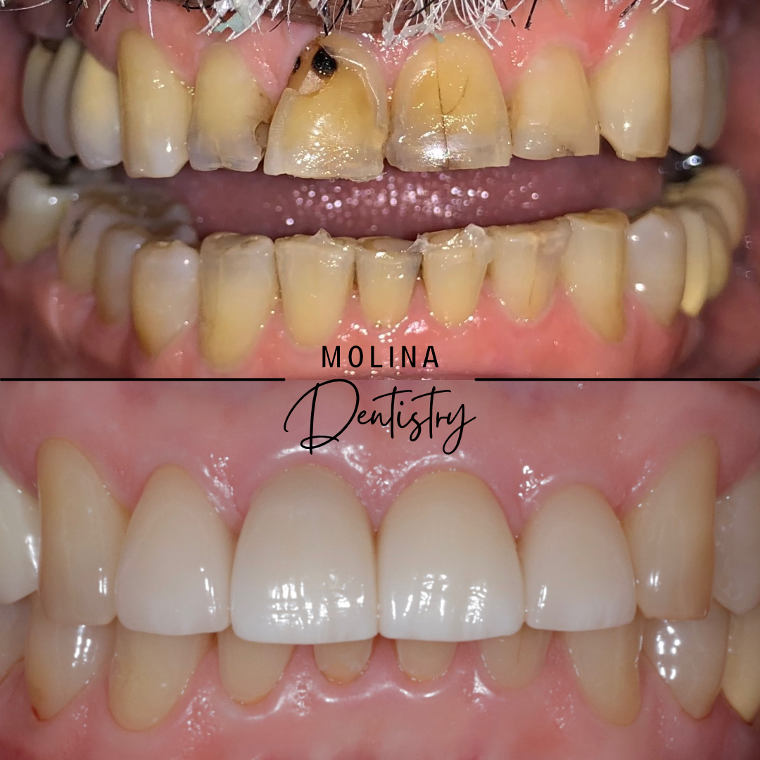 Smile Gallery - Molina Dentistry